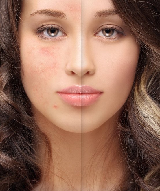 Acne scars reduction: Causes , Symptoms, Remedy & Skin Care Products ... Acne scars reduction: Causes , Symptoms, Remedy & Skin Care Products ...